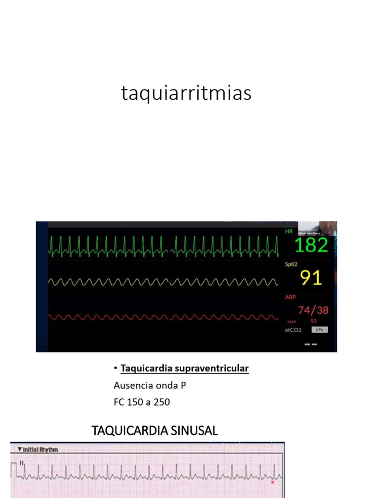 taquiarritmias insuf respit | PDF | Electrocardiografia | Enfermedades ...