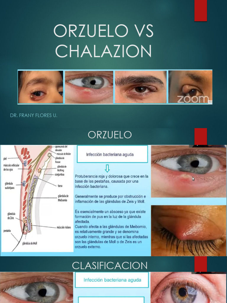 Orzuelo VS Chalazion | PDF