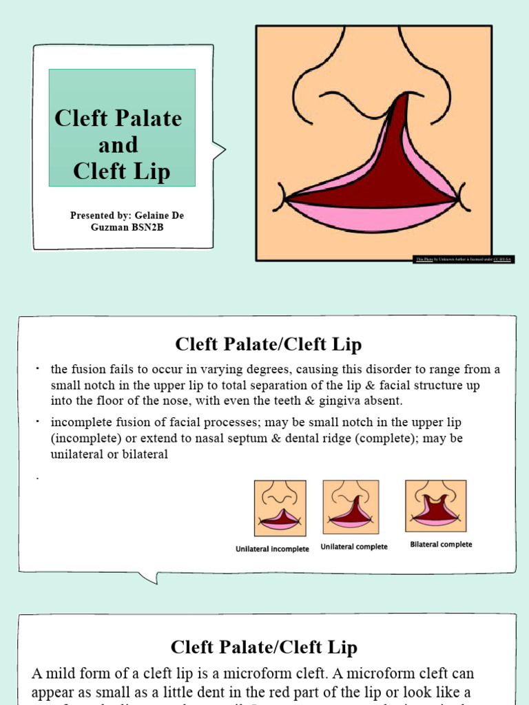 Cleft Palate (DeGuzman) | PDF | Clinical Medicine | Diseases And Disorders
