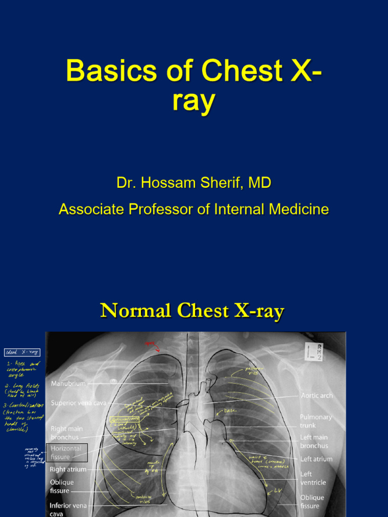 Chest x-rays 2 | Download Free PDF | Respiratory Diseases | Medical Specialties