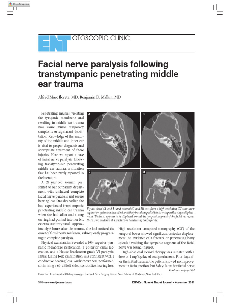 Iloreta Malkin 2011 Facial Nerve Paralysis Following Transtympanic ...