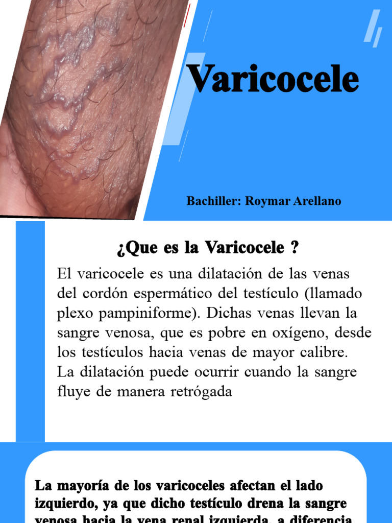 Varicocele Diapositivas | PDF | Causas de la muerte | Enfermedades y ...