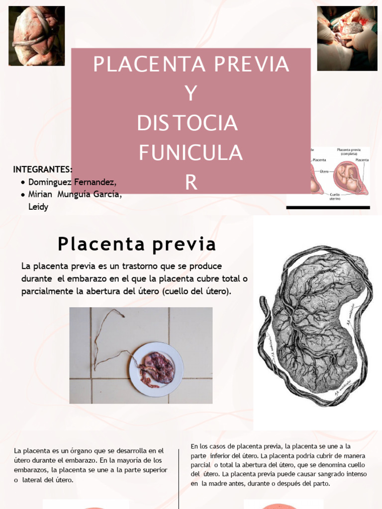 Placenta previa y distocia funicular (1) (2) | PDF | El embarazo | Parto
