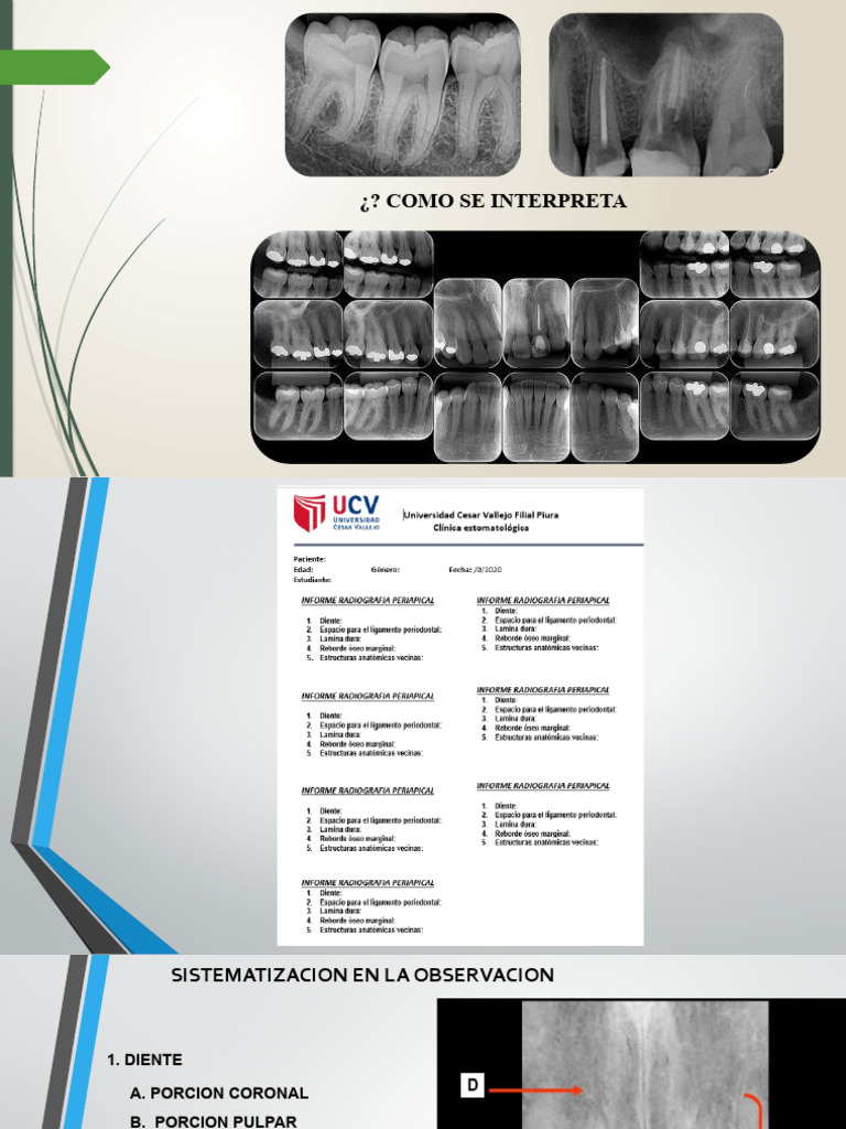Interpretacion RX Periapicales. Caries y Enf Periodontal | PDF ...