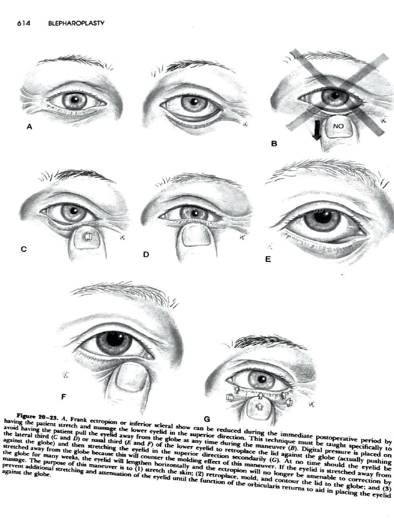 Eyelid Taping Technique for Entropion | PDF | Science & Mathematics