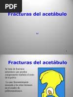 Fracturas de Cotilo: Clasificación y Tratamiento | PDF | Pelvis ...