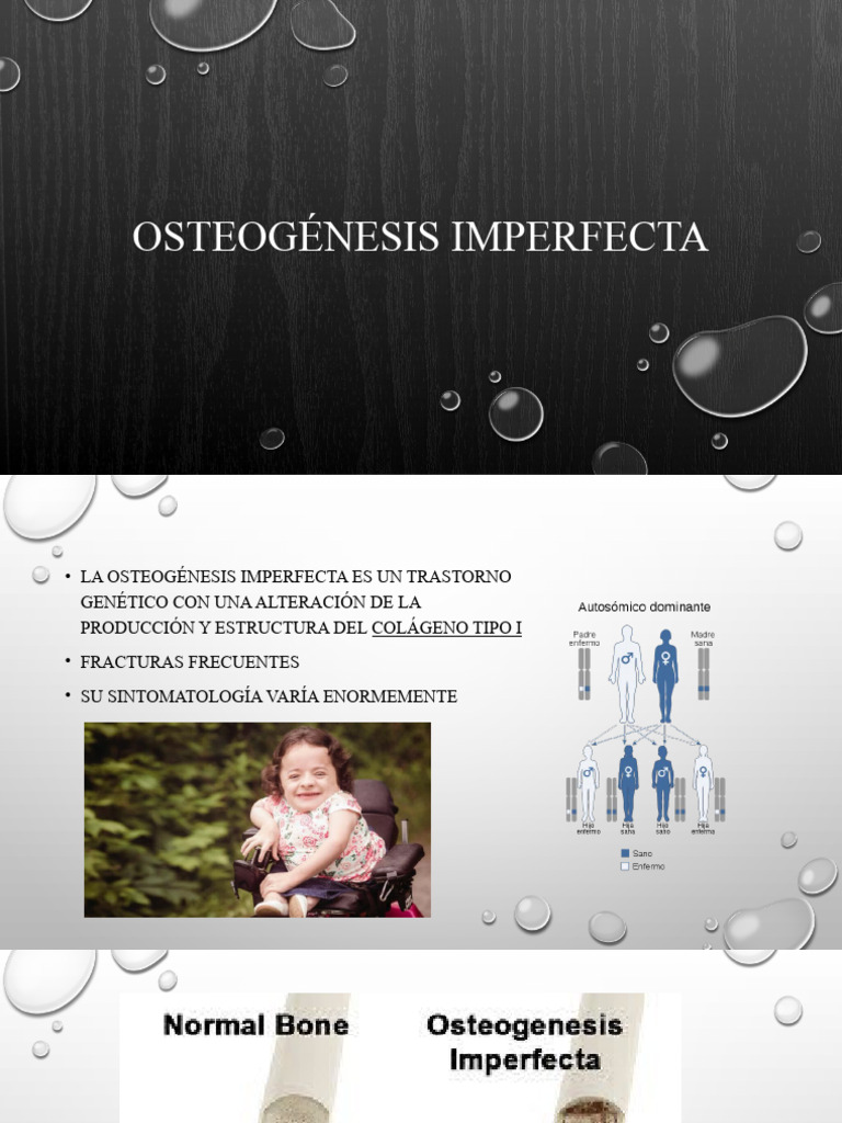 Osteogénesis Imperfecta: Síntomas y Tratamiento | PDF | Hueso | Hemofilia