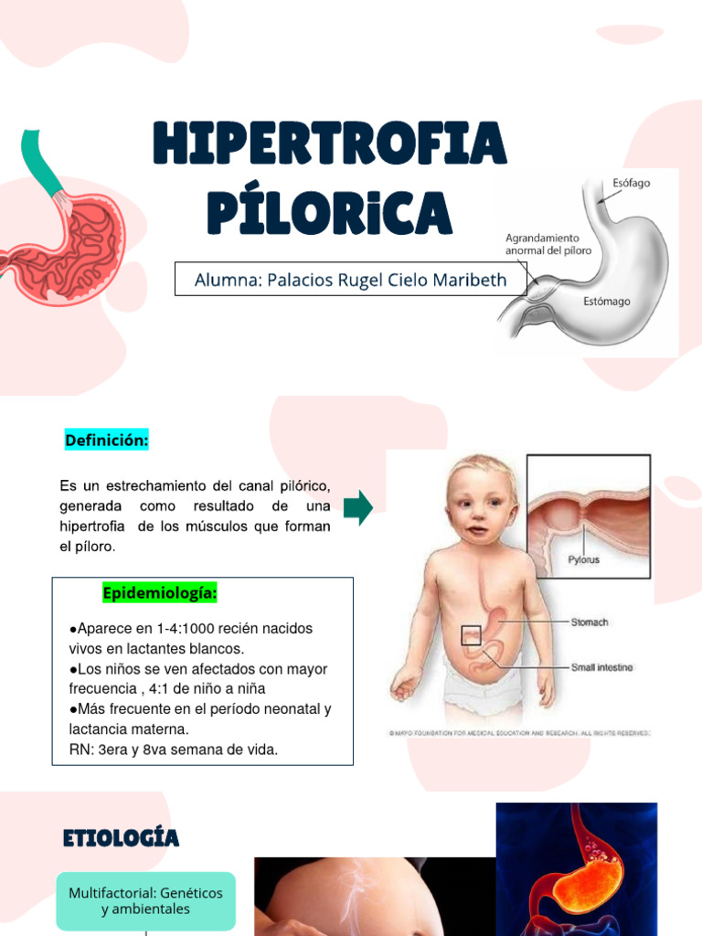 Hipertrofia de Piloro | PDF | Abdomen | Heces