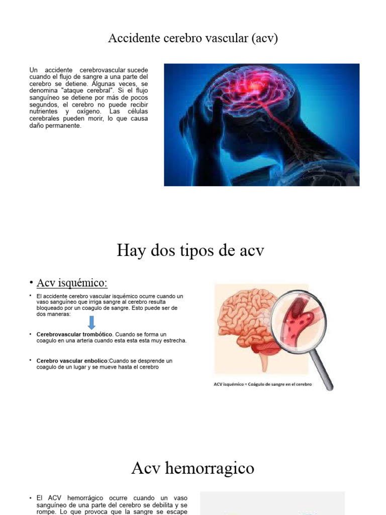 Accidente Cerebro Vascular (Acv) | PDF | Cocina, comidas y vino