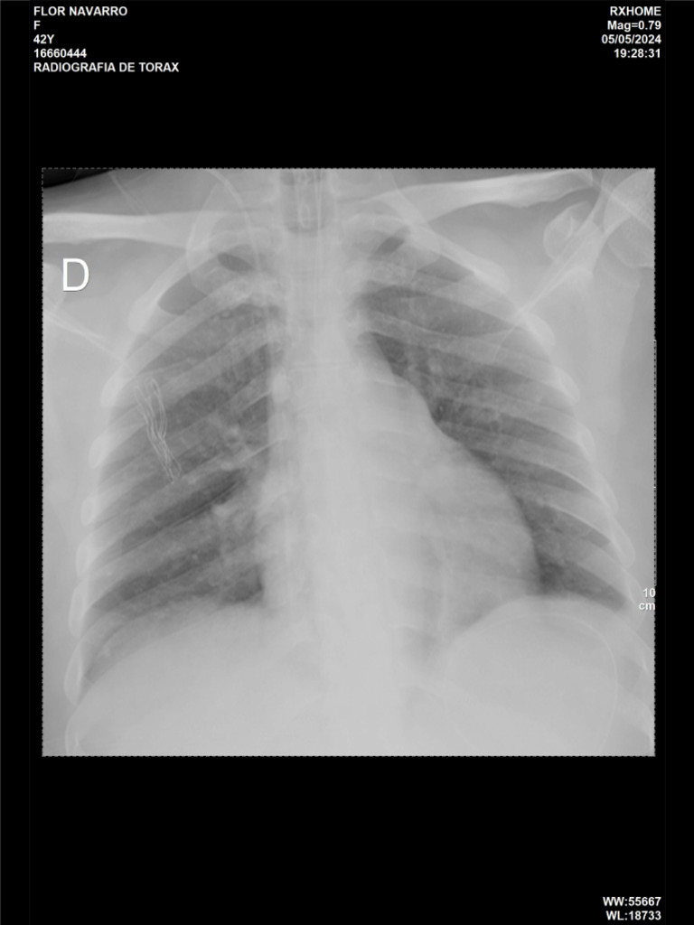 RX Torax en Paciente Con TBC Miliar | PDF