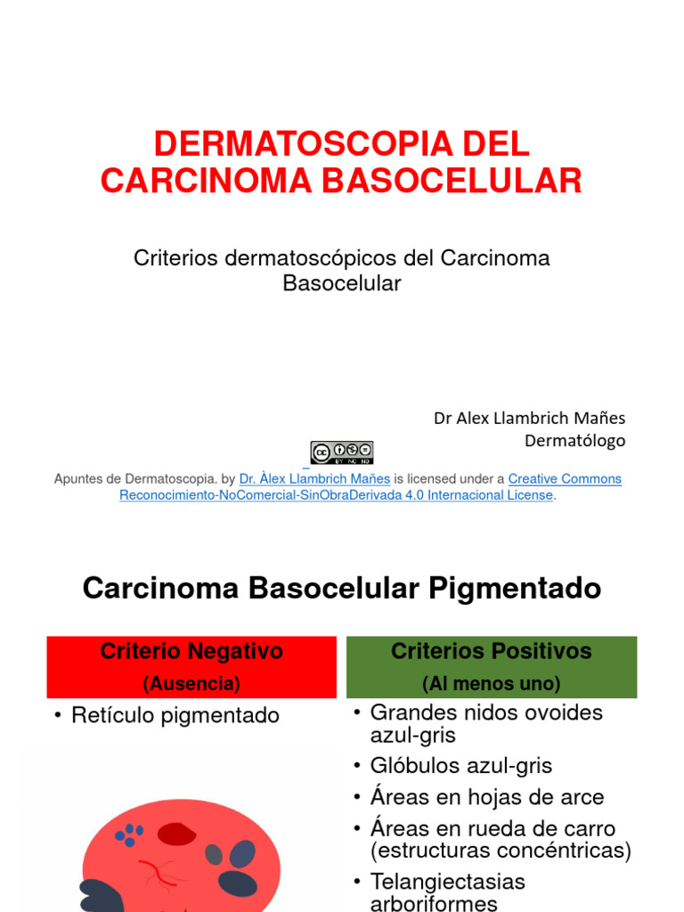 5.dermatoscopia Del Carcinoma Basocelular | PDF