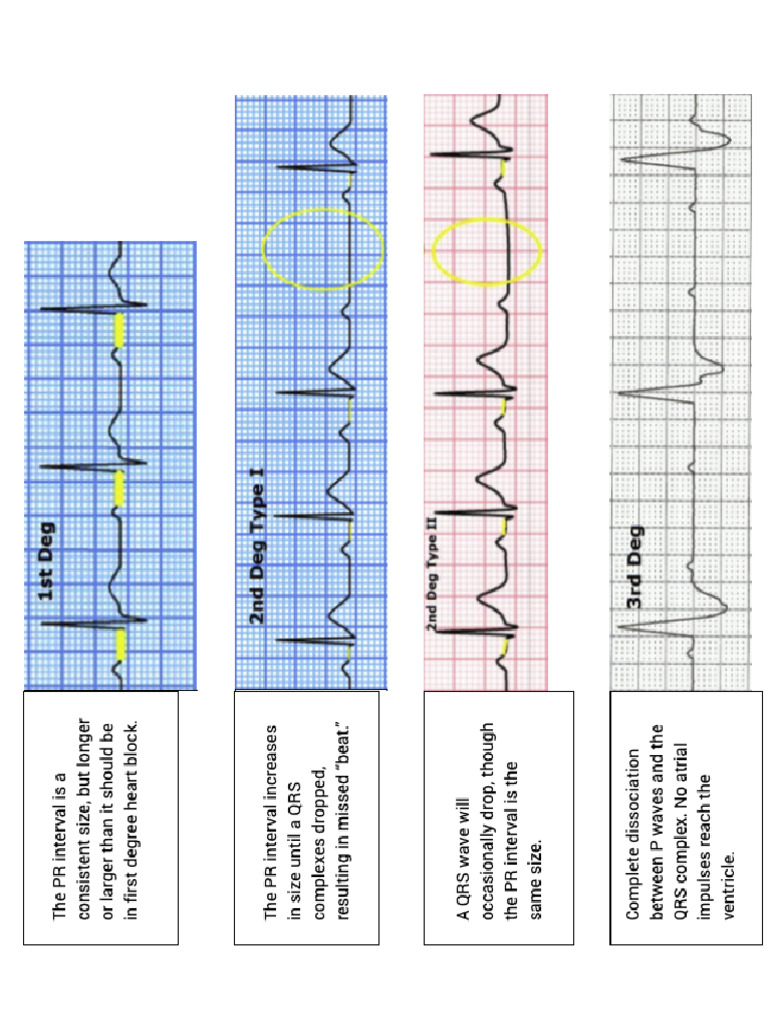 Types of Heartblocks | PDF