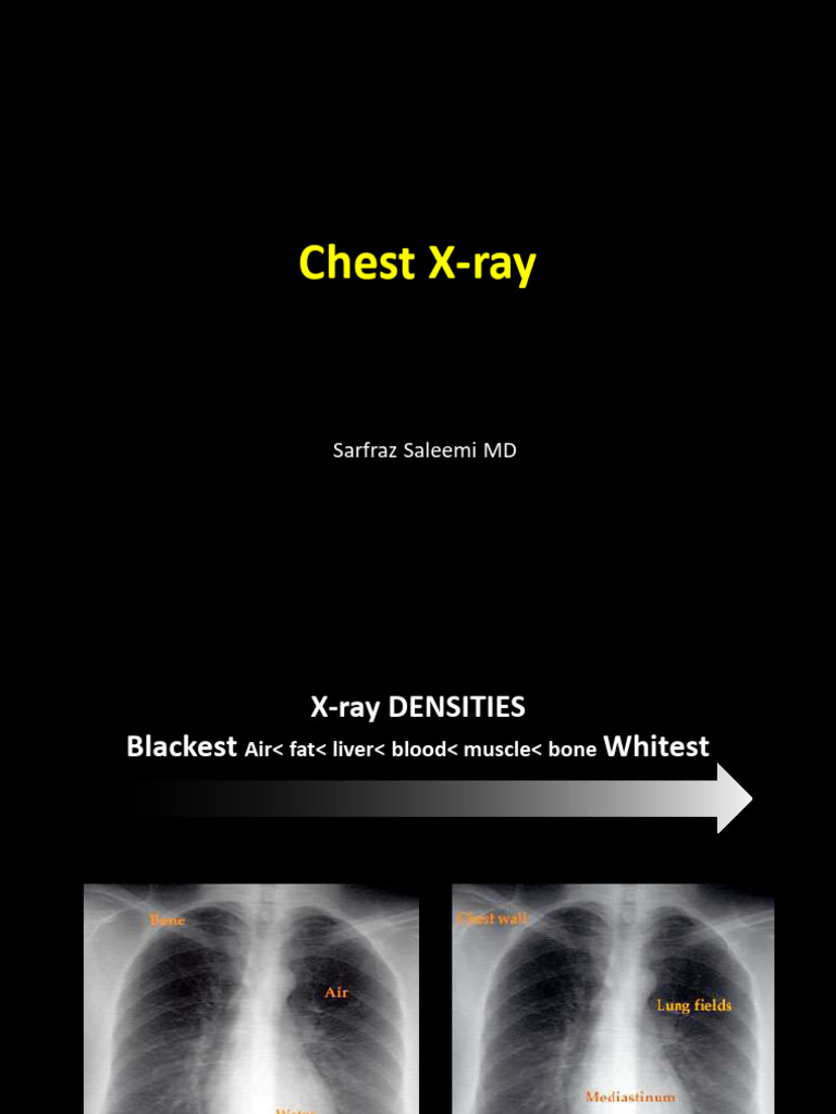 Chestx Ray 180216035142 | PDF | X Ray | Imaging