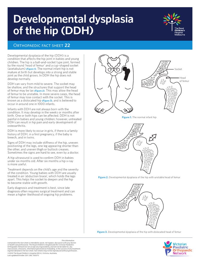 Developmental Dysplasia of The Hip (DDH) : Orthopaedic Fact Sheet 22 | PDF | Medical Specialties ...