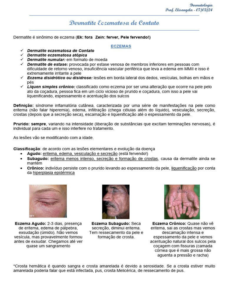 Dermatite de Contato (Eczema) Desg | PDF | Dermatite | Célula T