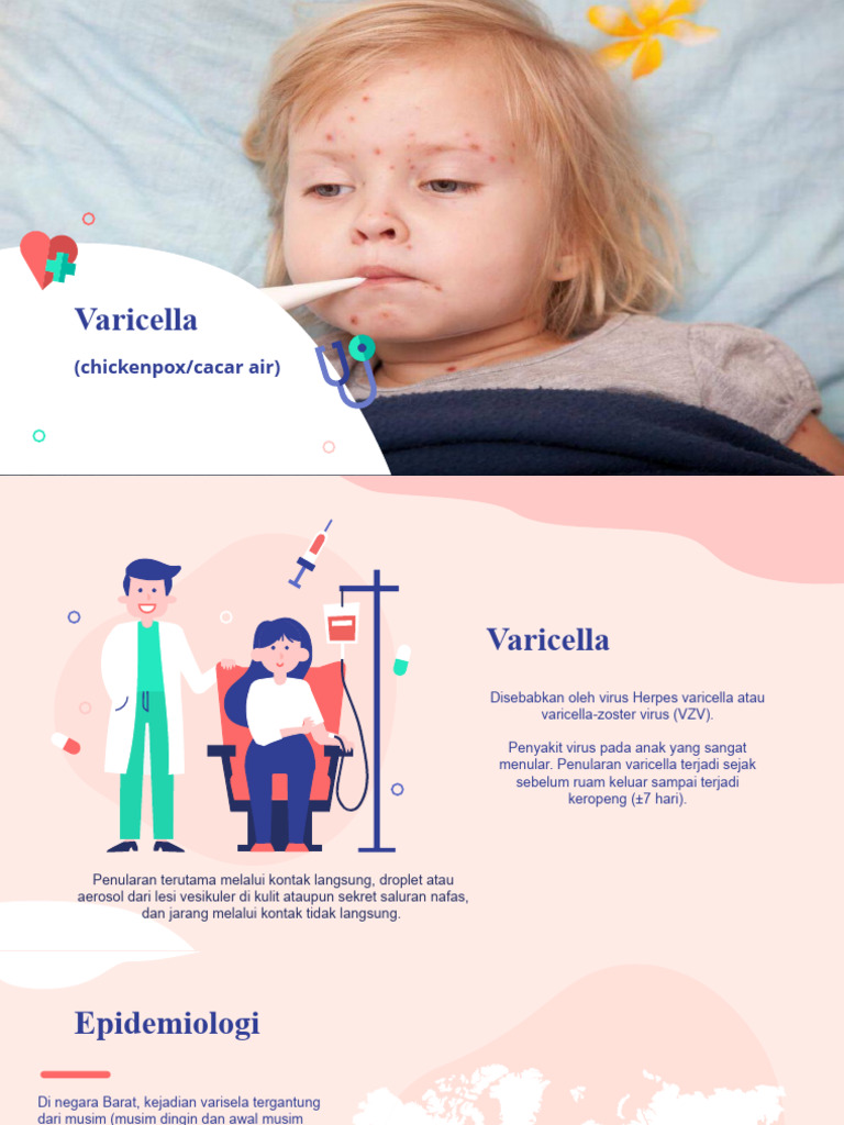 Varicella (Chickenpox) | PDF