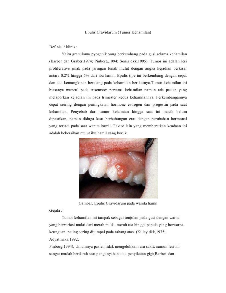 Epulis Pregnancy