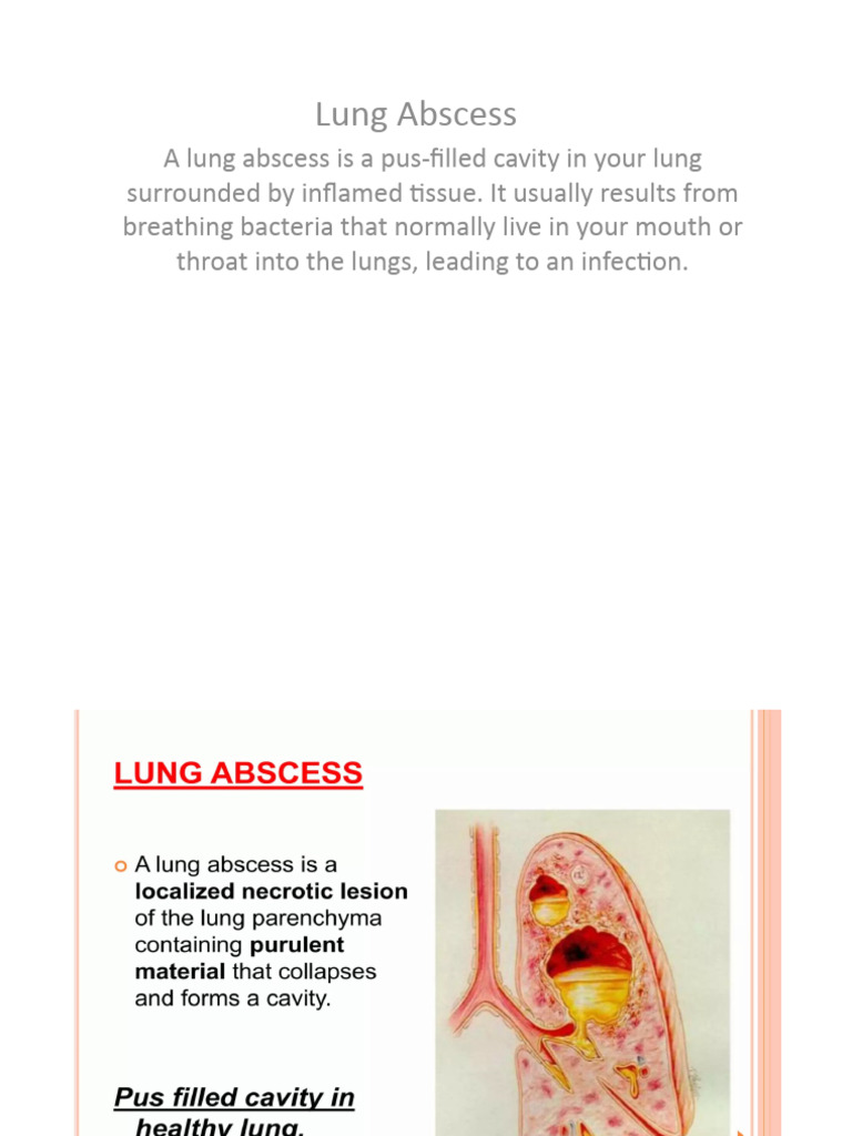 Understanding Lung Abscess: Symptoms & Treatment | PDF | Science ...