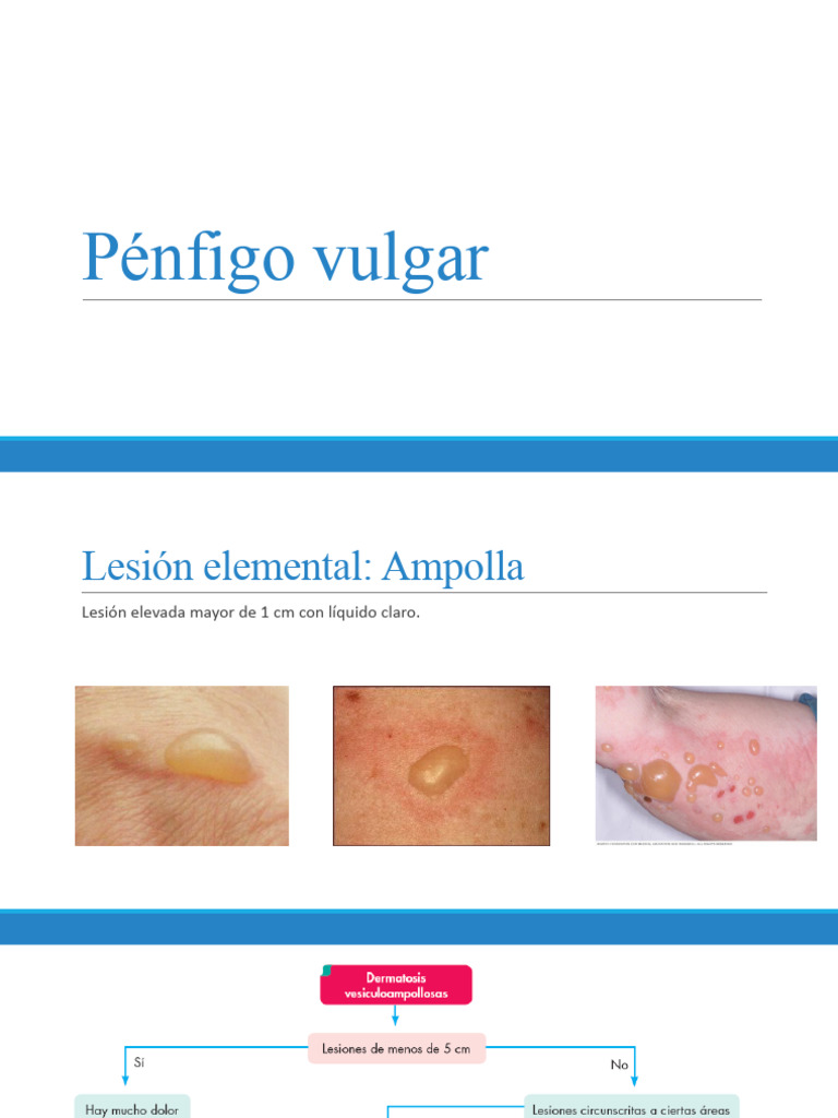 Pénfigo Vulgar | PDF | Condiciones cutáneas | Inmunología