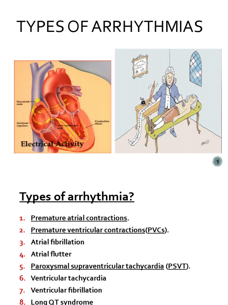4a. Types of Arrhythmias | PDF | Heart | Cardiac Arrhythmia