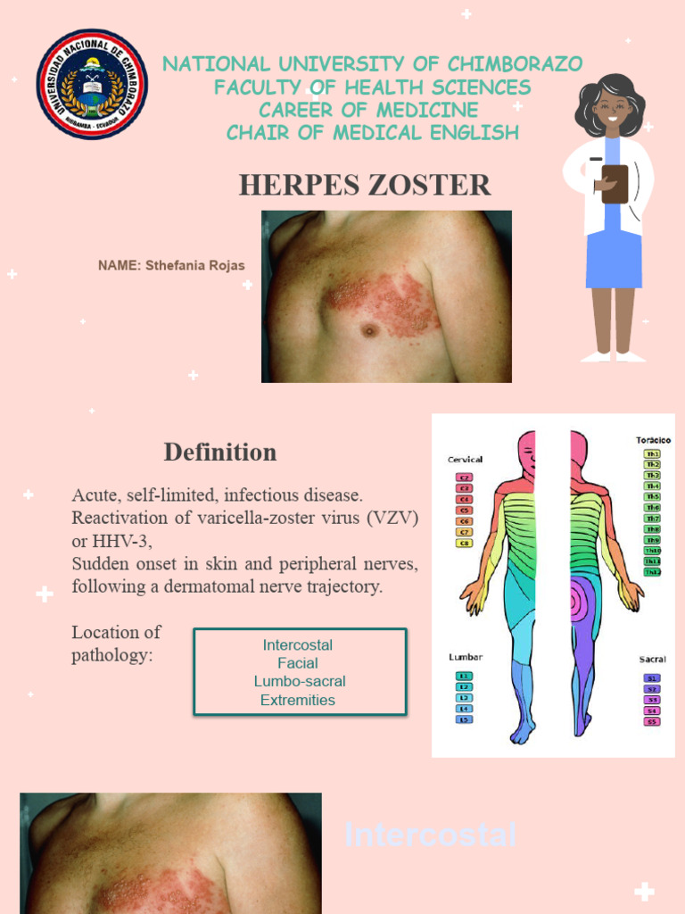 herpes zoster | PDF