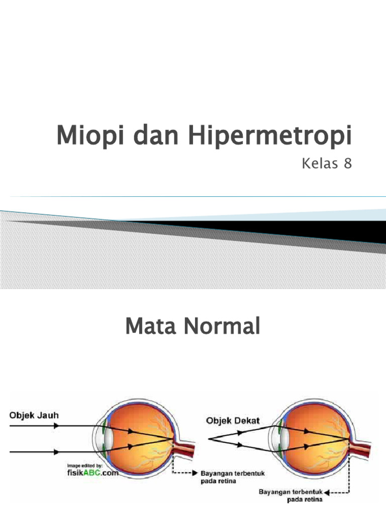 Miopi Dan Hipermetropi | PDF