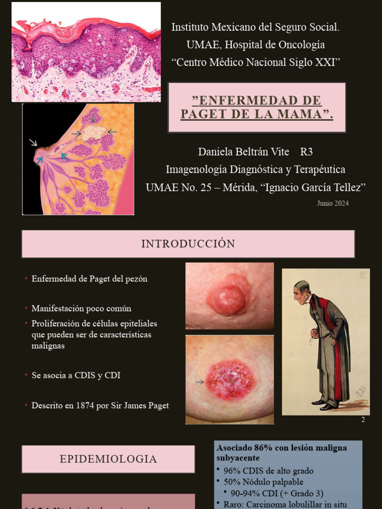 Enfermedad de Paget de La Mama | PDF | Cáncer de mama | Cáncer
