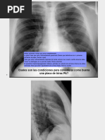 Guía de Signos Radiológicos de Tórax | PDF | Pulmón | Neumonía