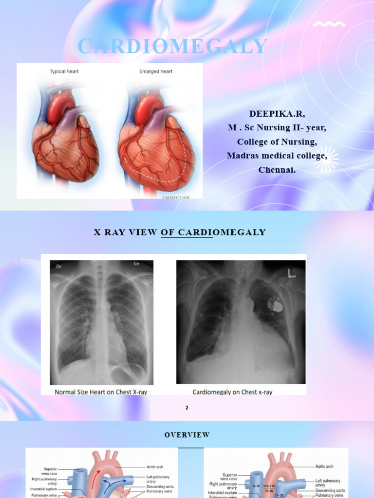Cardiomegaly | PDF | Heart | Heart Failure