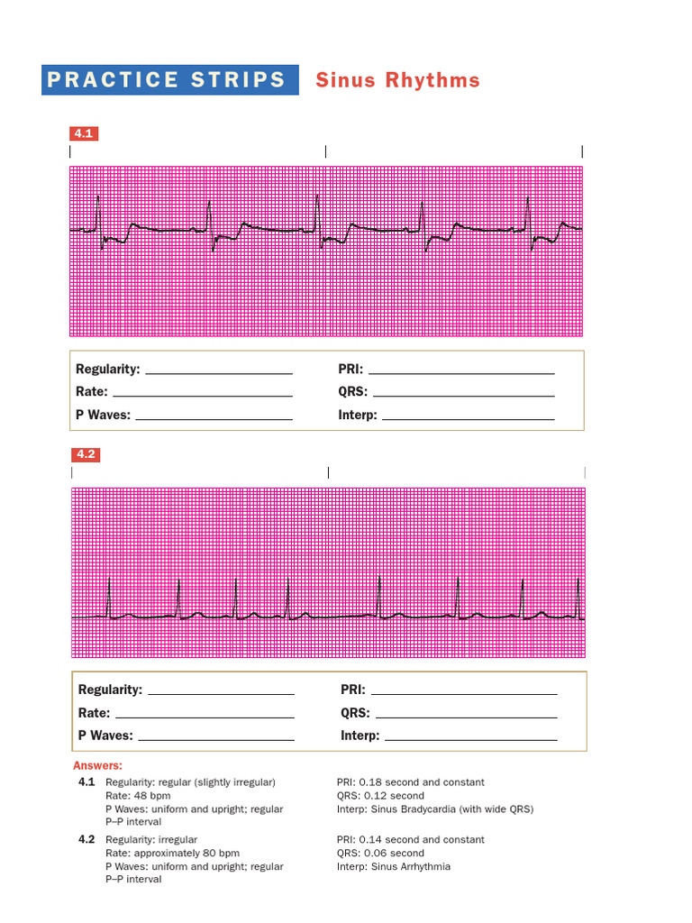 EKG Sinus | PDF | Physiology | Diseases And Disorders