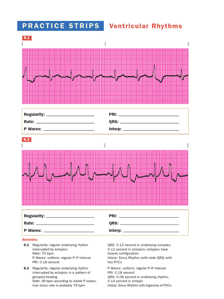 EKG Ventricular Rhythms | PDF | Diseases And Disorders | Electrophysiology