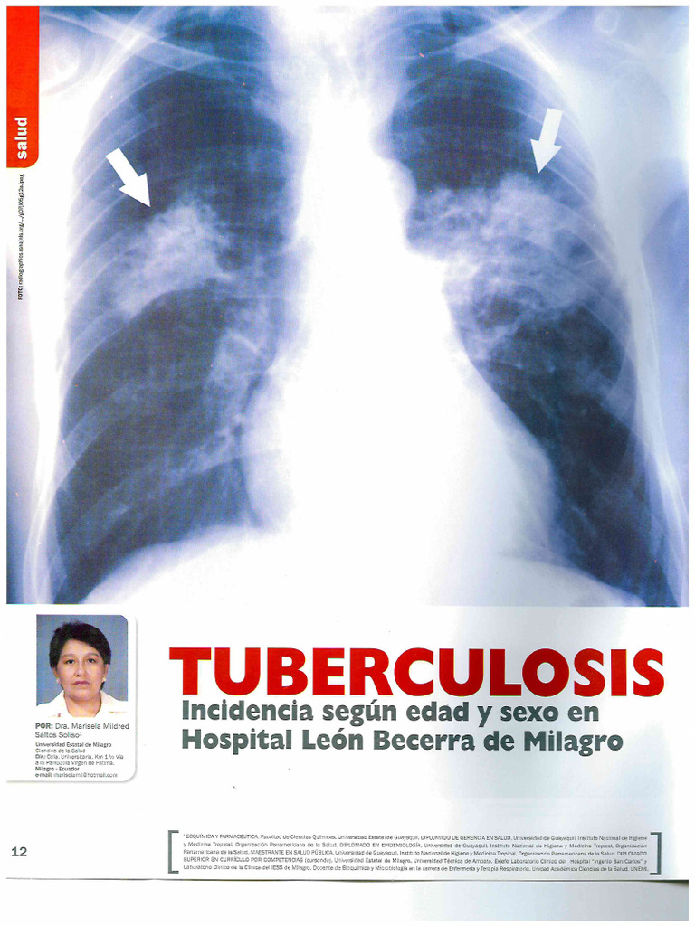 Tuberc: Incidencia Hospital | PDF