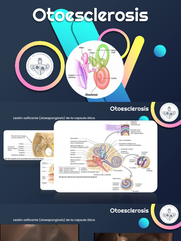 Otoesclerosis | PDF | Sistema Auditorio | Especialidades Medicas