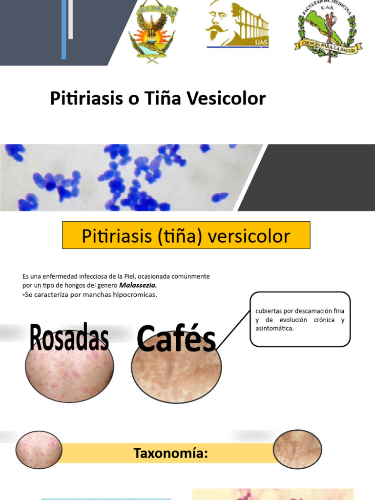Pitiriasis TIÑA VERSICOLOR | PDF | Especialidades Medicas ...