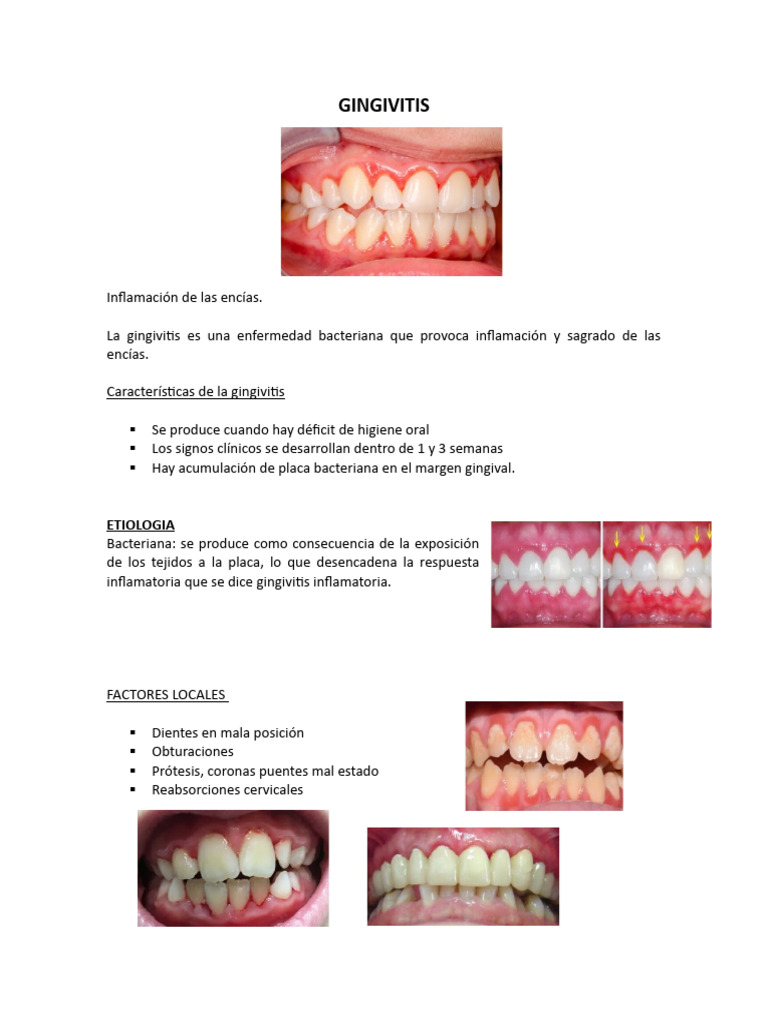 Guía Completa sobre Gingivitis | PDF | Especialidades Medicas | Medicina