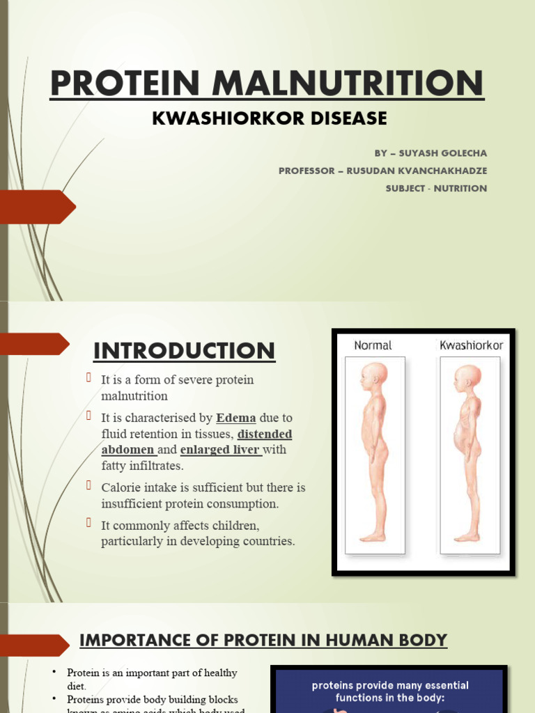 PROTEIN MALNUTRITION | Download Free PDF | Malnutrition | Edema