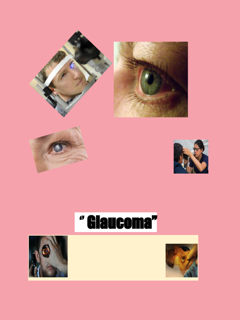 Glaucoma Download Free Pdf Glaucoma Clinical Medicine