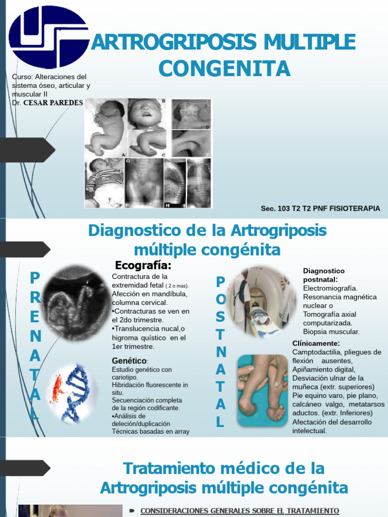 Diagnóstico y Tratamiento de Artrogriposis | PDF | Terapia física ...