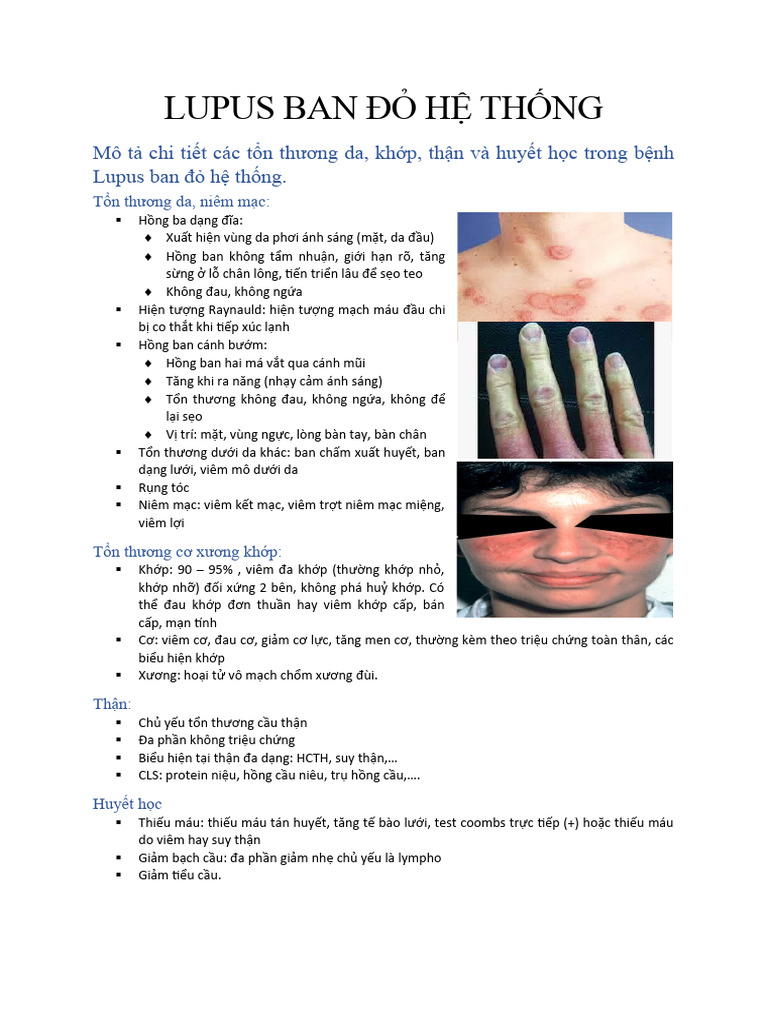 LUPUS BAN ĐỎ HỆ THỐNG | PDF