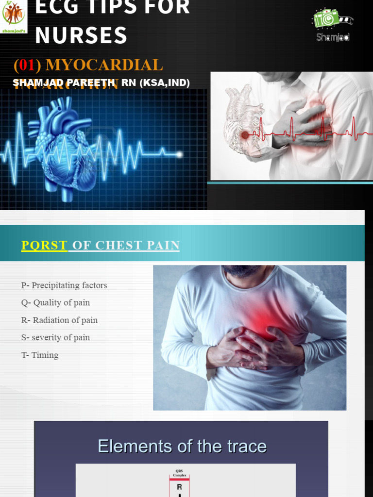 Ecg Mi | PDF