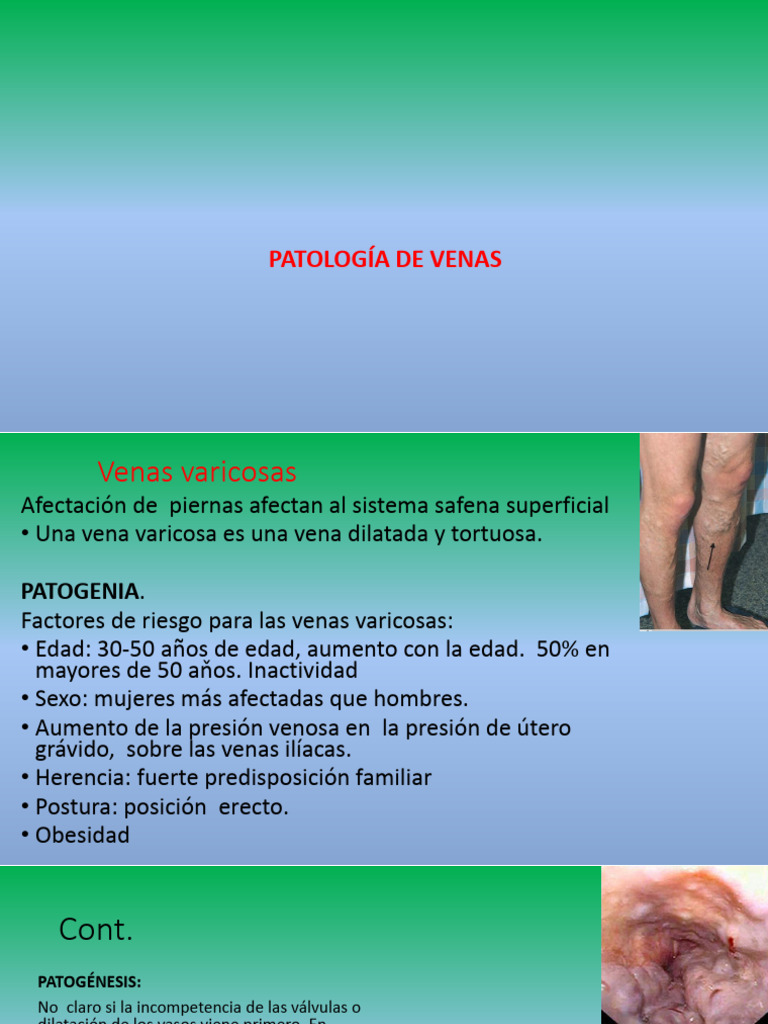 Varices Abdominales en Hombres | PDF | Inflamación | Venas varicosas