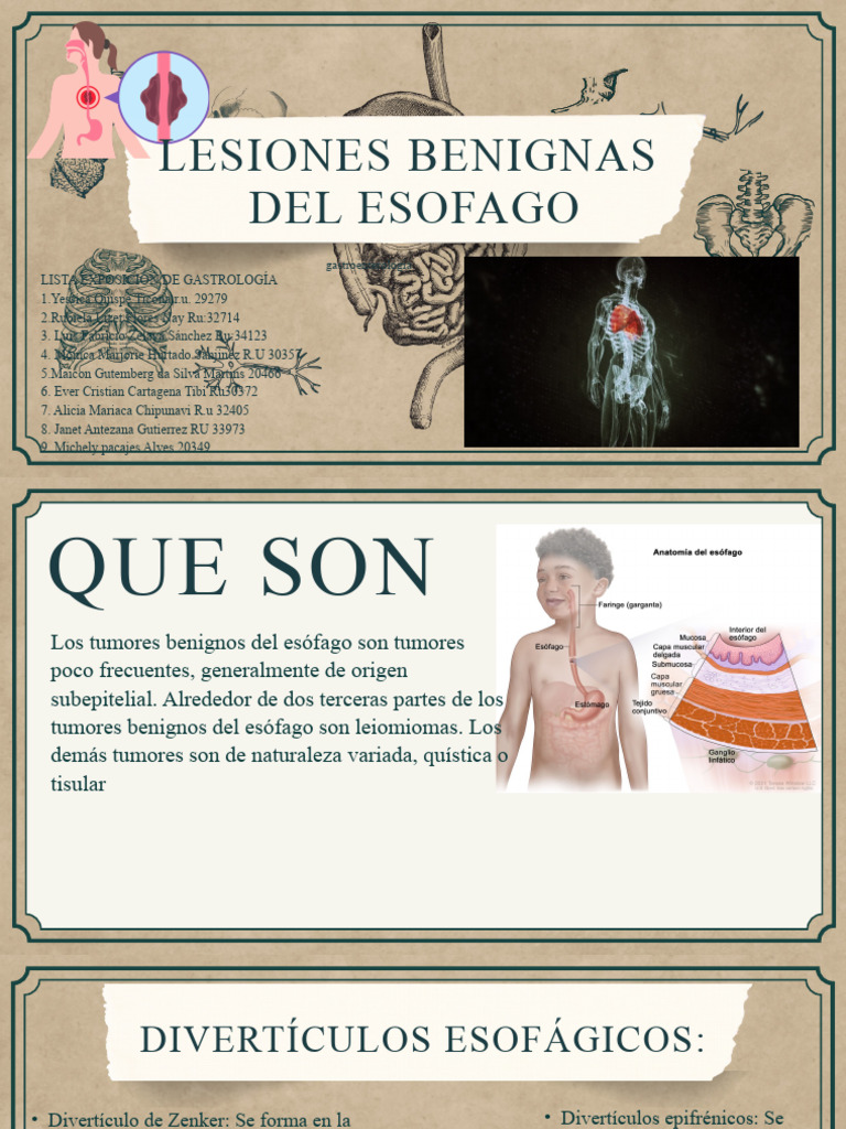Lesion Esofago | PDF | La enfermedad por reflujo gastroesofágico ...
