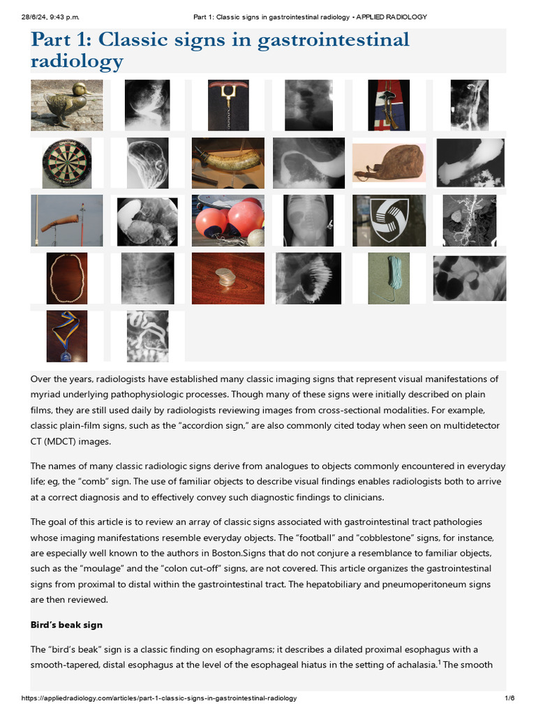 Corkscrew Sign in Midgut Volvulus Radiology | PDF | Esophagus | Stomach