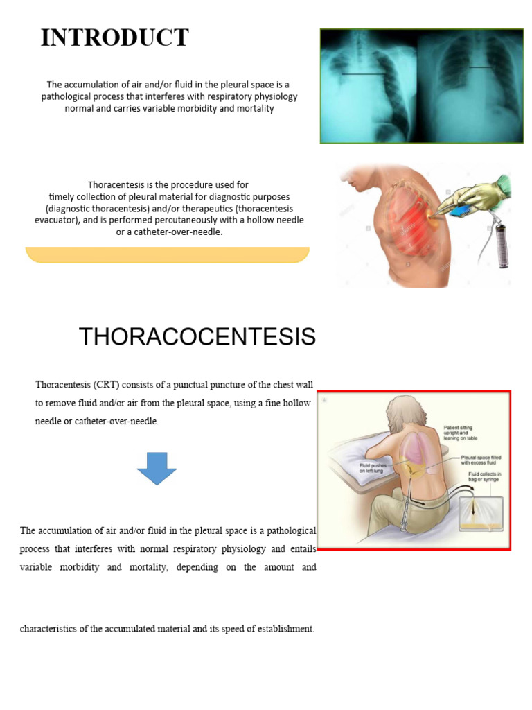 THORACOCENTESIS | Download Free PDF | Clinical Medicine | Medicine