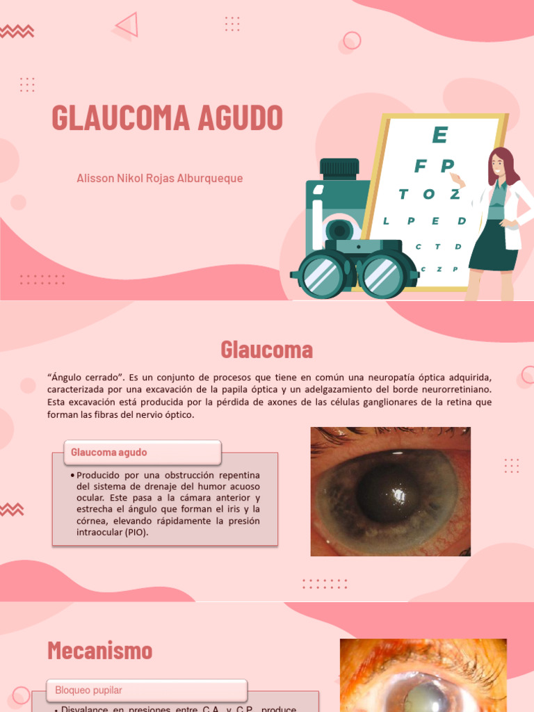 Glaucoma Agudo: Diagnóstico y Tratamiento | PDF | Glaucoma | Especialidades Medicas