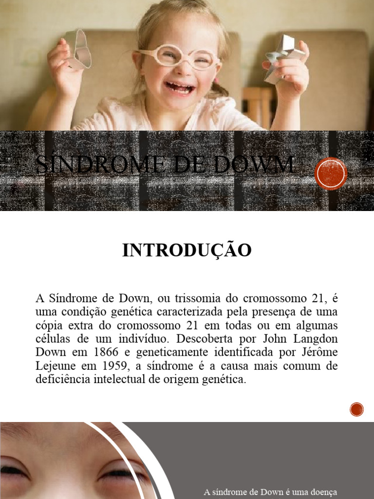 Síndrome de Down: Causas e Características | PDF | Síndrome de Down ...