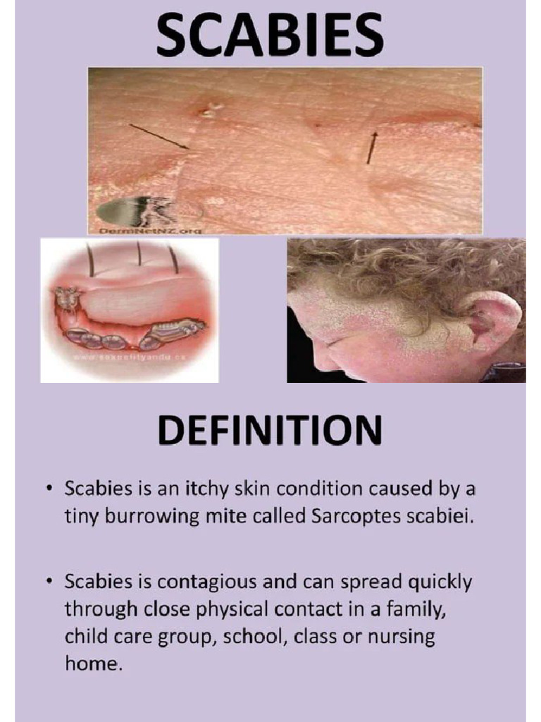 Scabies | PDF