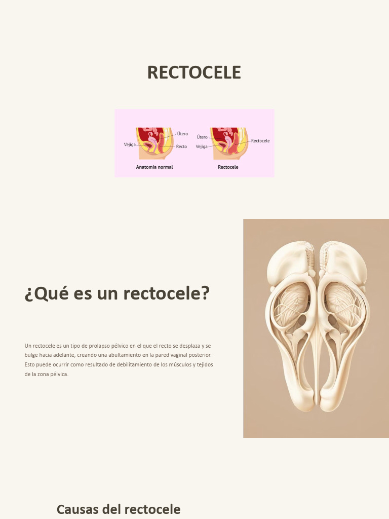 Rectocele 1 | PDF | Estreñimiento | Especialidades Medicas