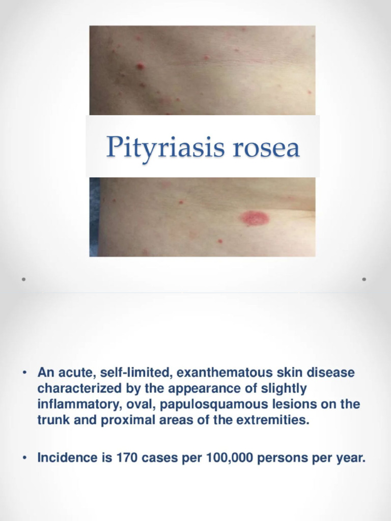 LBM 2 - Pityriasis Rosea | PDF