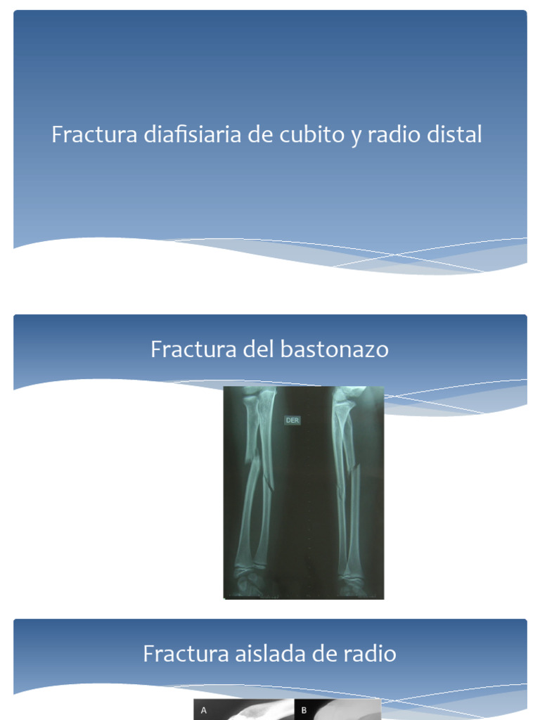 Fracturas de cúbito y radio distal | PDF